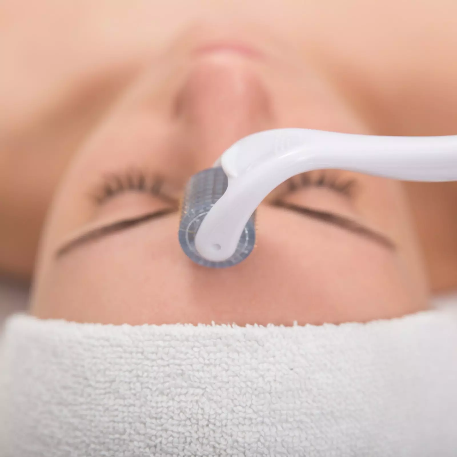 Nwanyị na-enweta ọgwụgwọ microneedling n'ụlọ ọrụ ndị dọkịta gbasara akpụkpọ ahụ