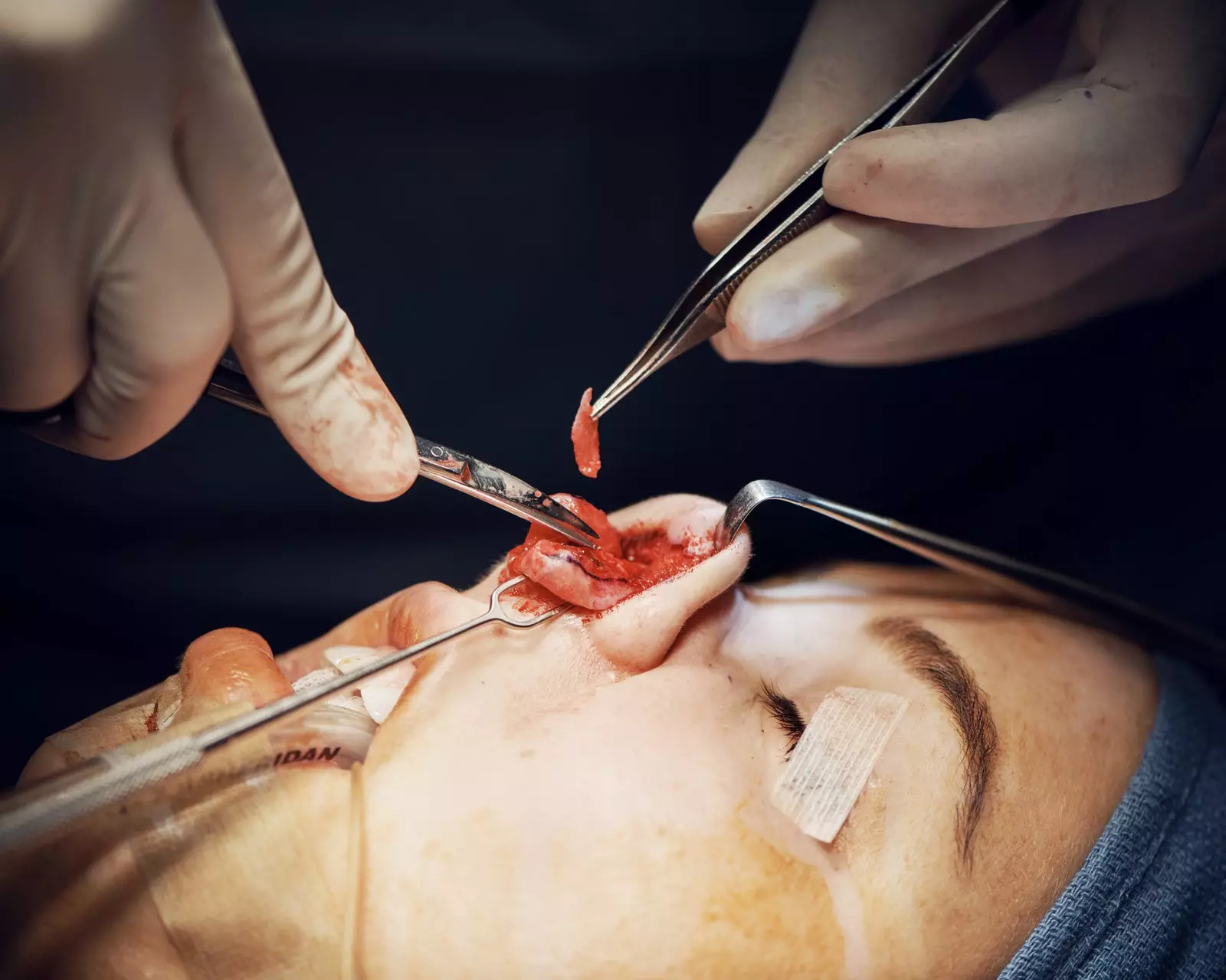 fotos del proceso de rinoplastia para la vida de allure.com en columna de plástico