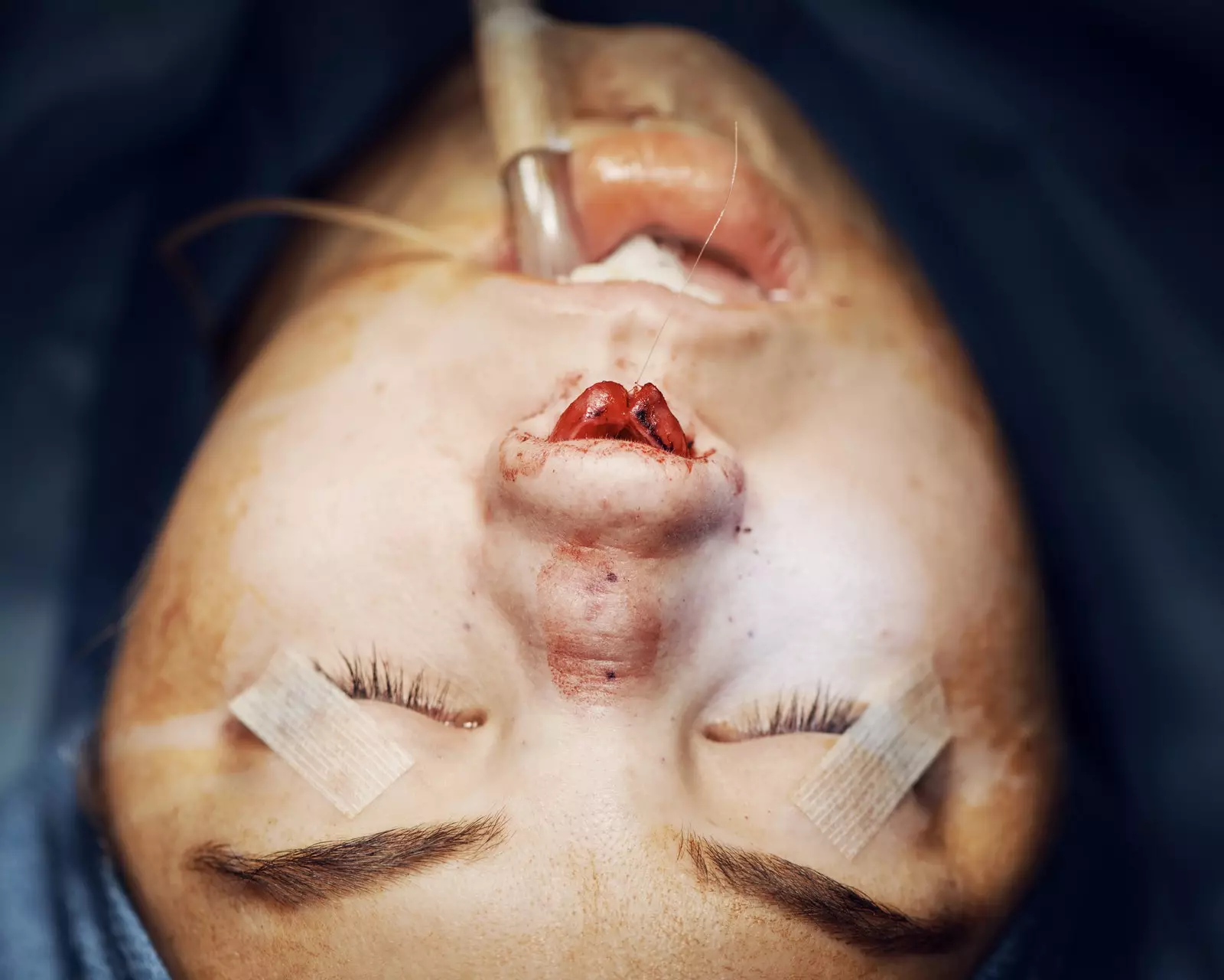 fotos de nariz de rinoplastia para la vida de allure.com en columna de plástico