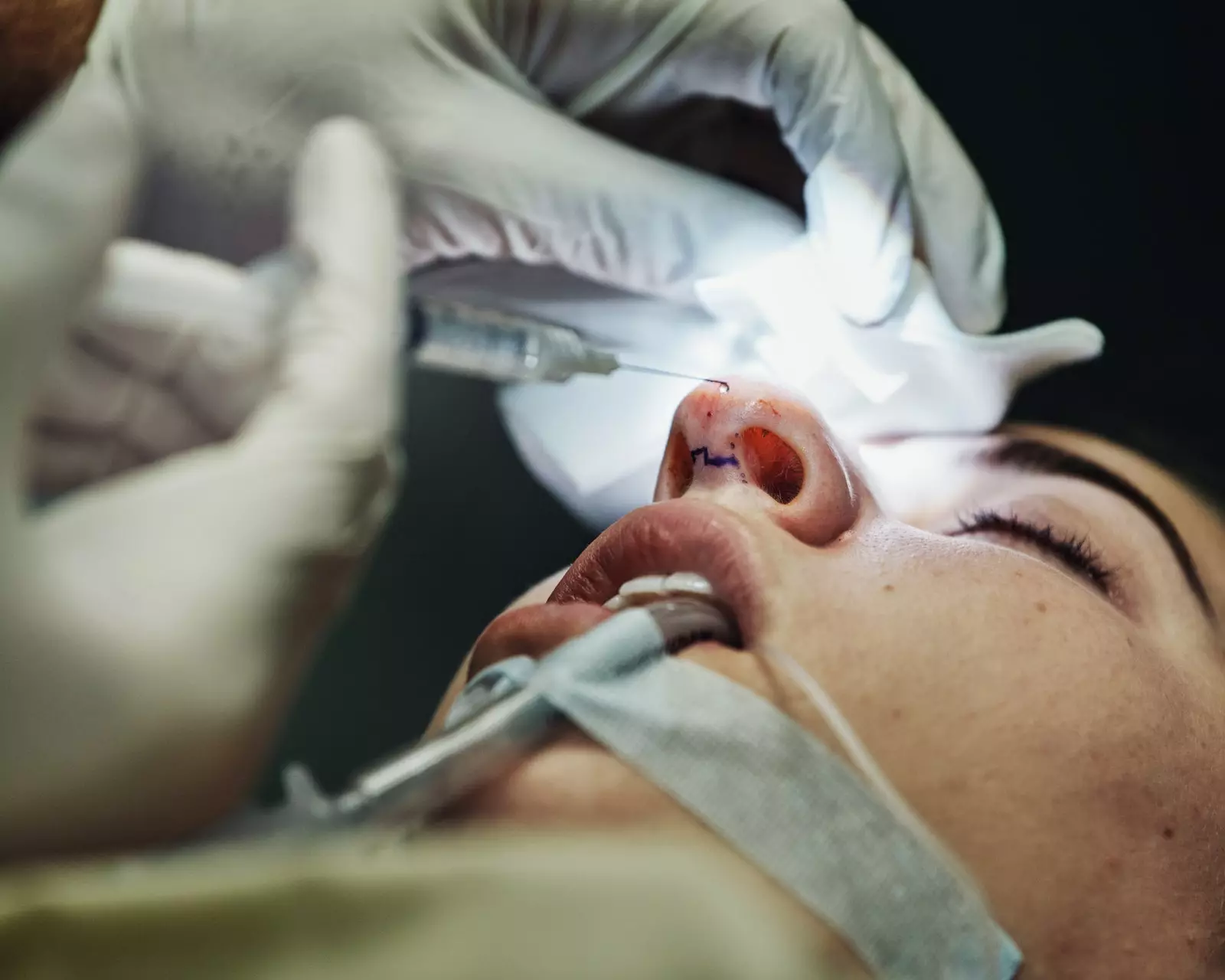 fotos del proceso de rinoplastia para la vida de allure.com en columna de plástico