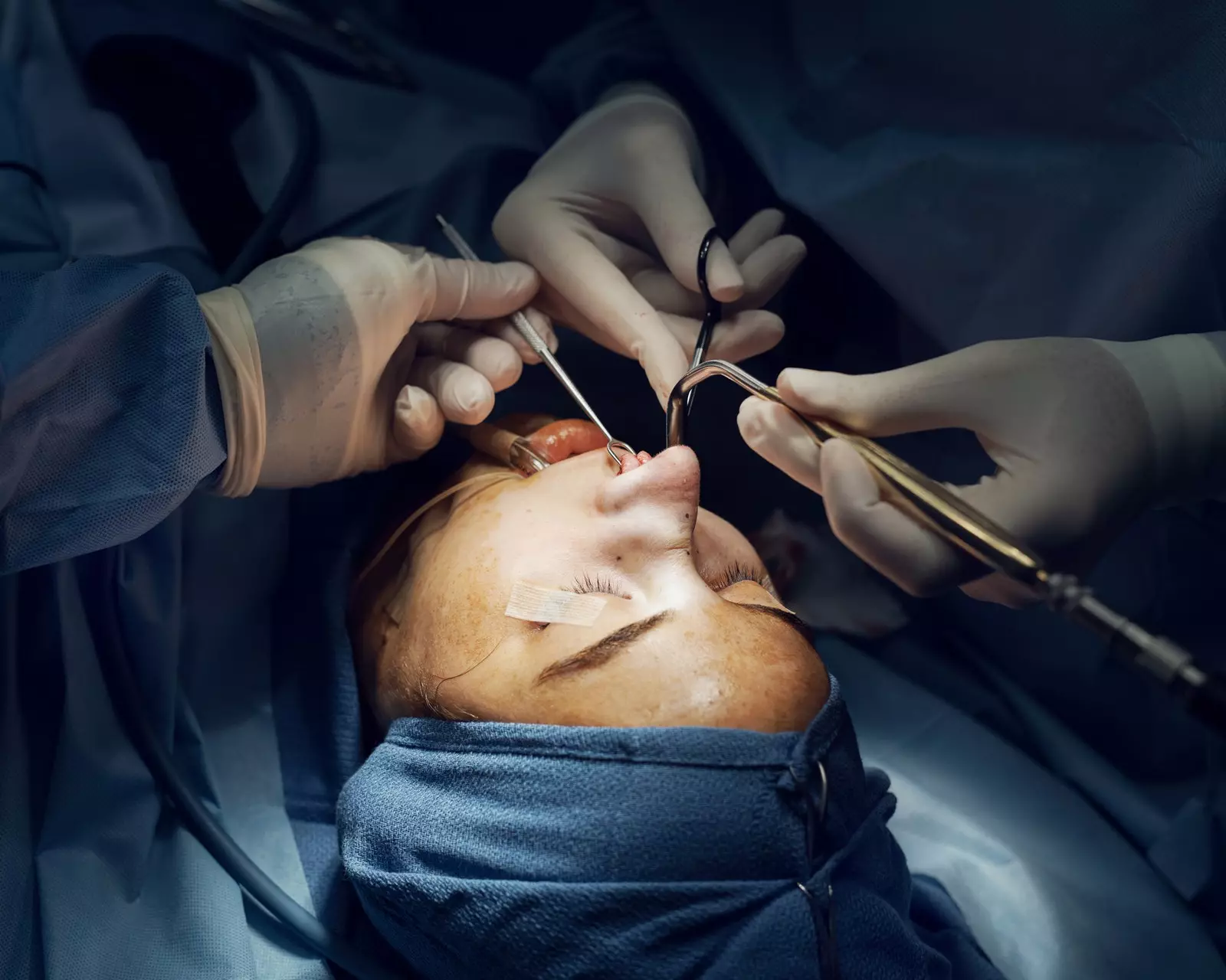 fotos del proceso de rinoplastia para la vida de allure.com en columna de plástico